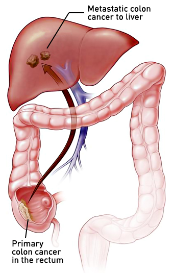 Sirtex Liver Metastases